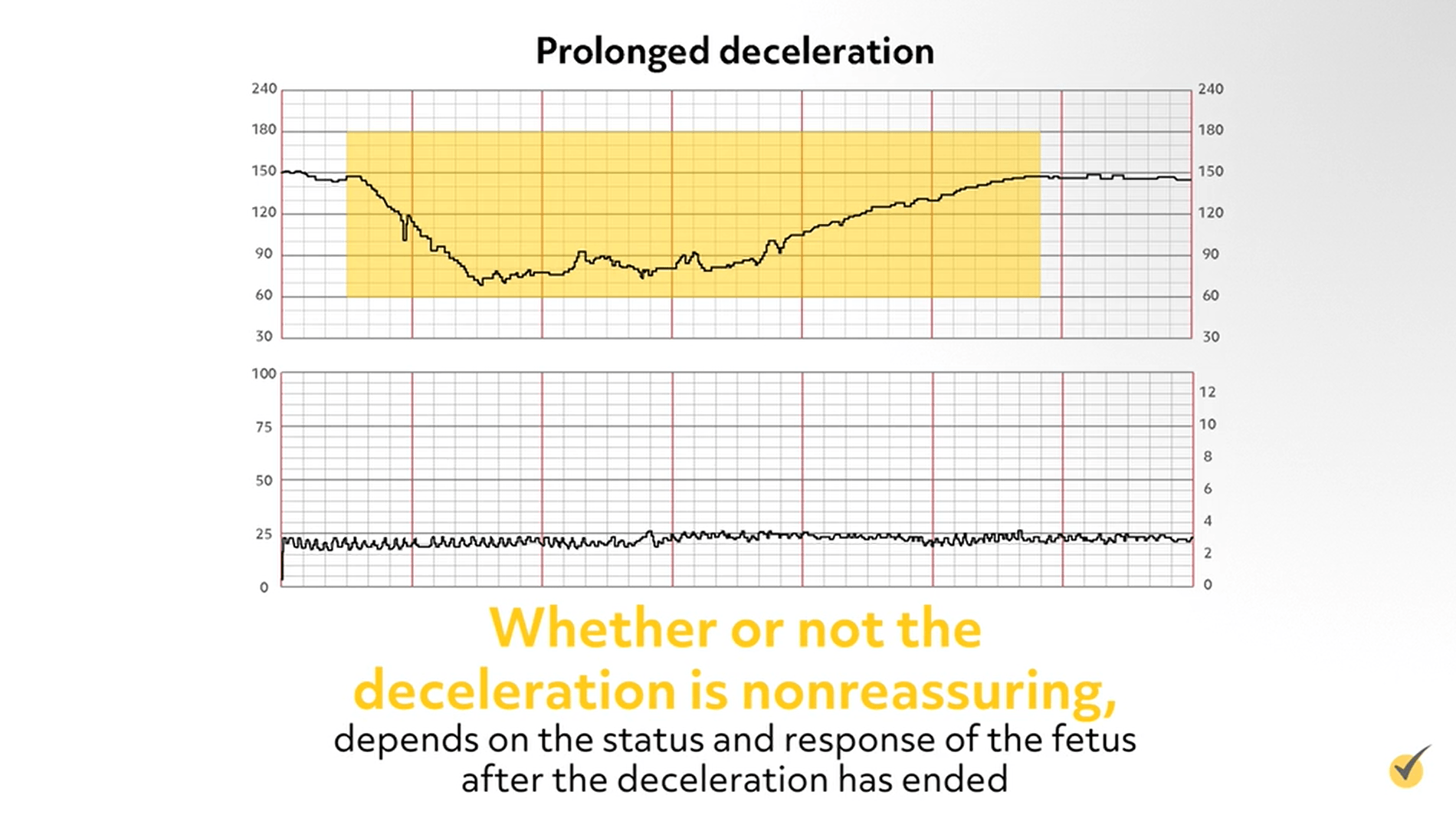 Reactive Fetal Heart Rate Tracing